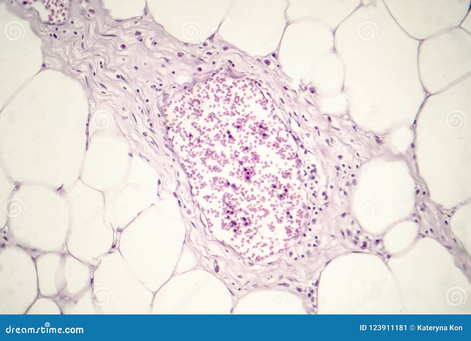 Lipoom, De Goedaardige Groei Van Vettig Weefsel Stock Afbeelding ...