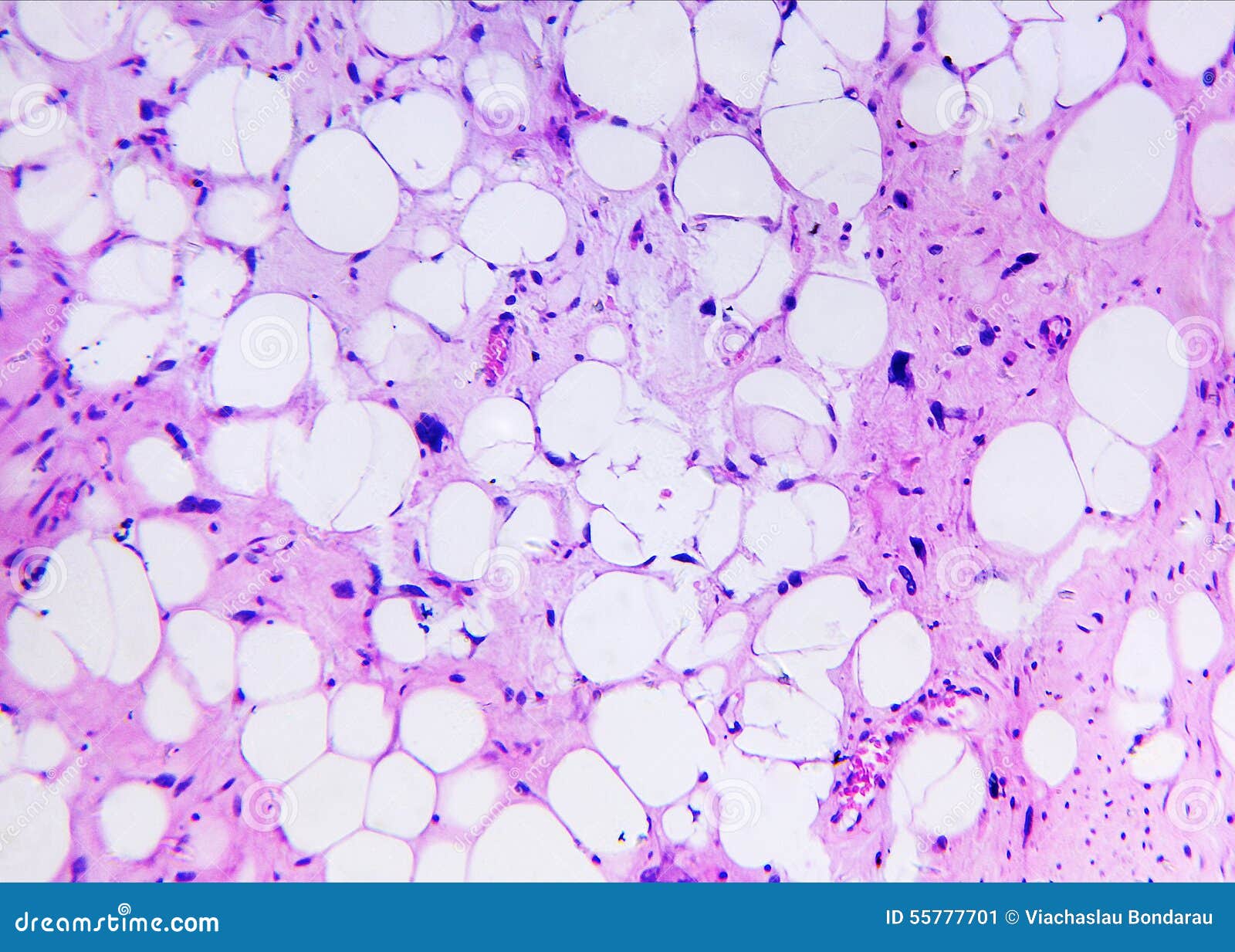 Liposarcoma Of A Human Stock Photo - Image: 55777701