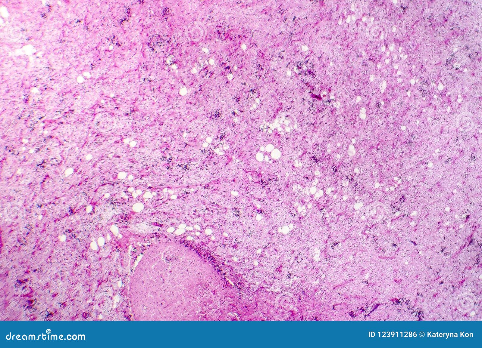 Liposarcoma, Soft Tissue Sarcoma Royalty-Free Stock Photo ...