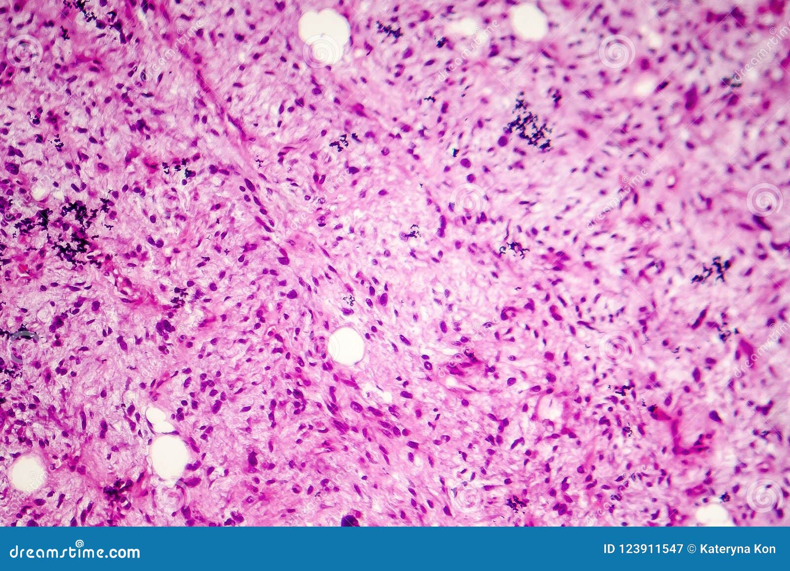 Liposarcoma, Soft Tissue Sarcoma Stock Image - Image of microphotograph ...