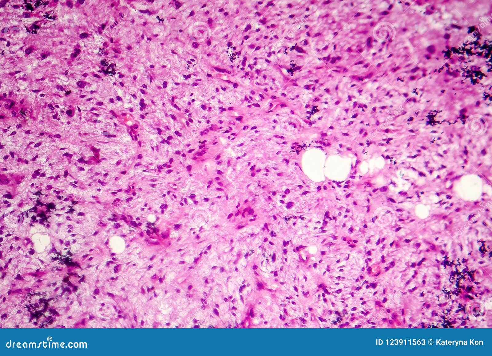 Liposarcoma, Soft Tissue Sarcoma Royalty-Free Stock Photo ...