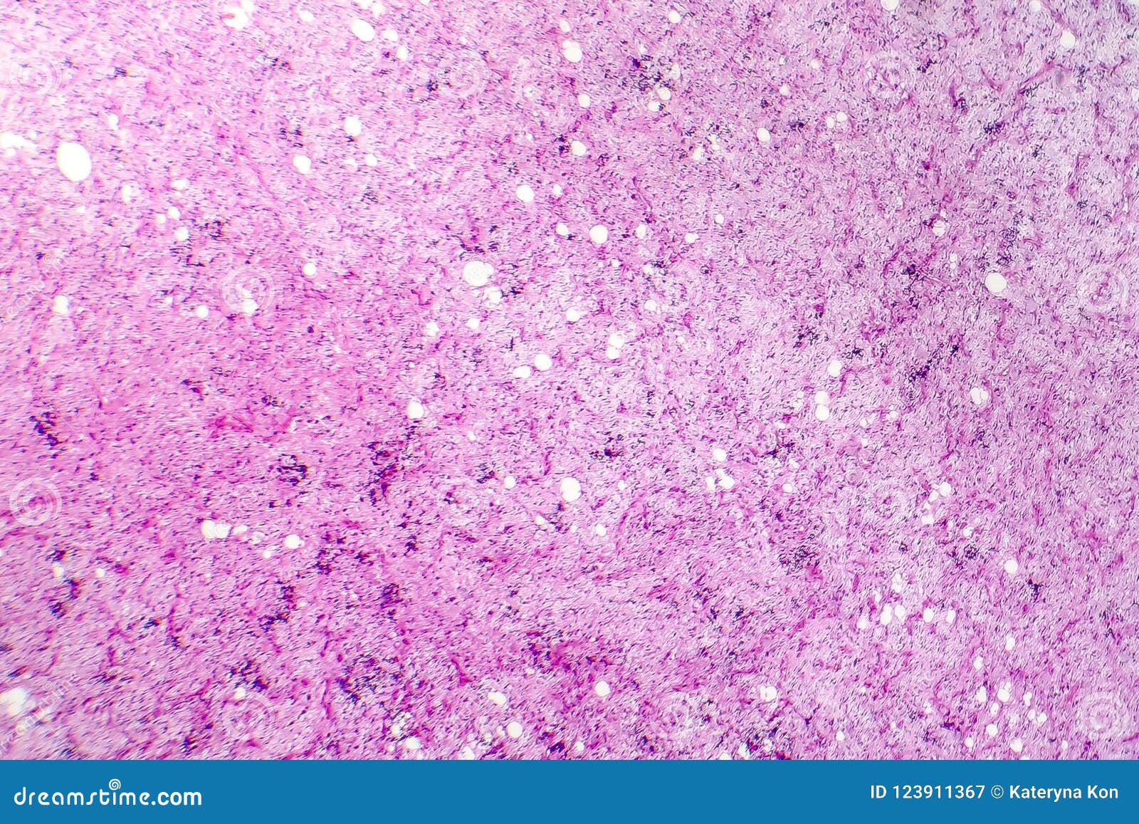 Liposarcoma, Soft Tissue Sarcoma Stock Image - Image of soft ...