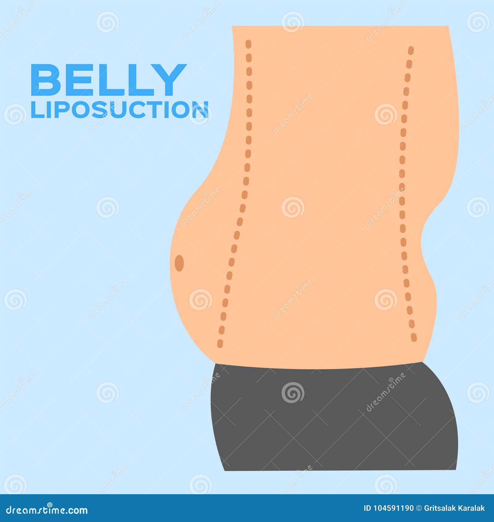 Liposuction body set . stock vector. Illustration of hypodermic - 104591190