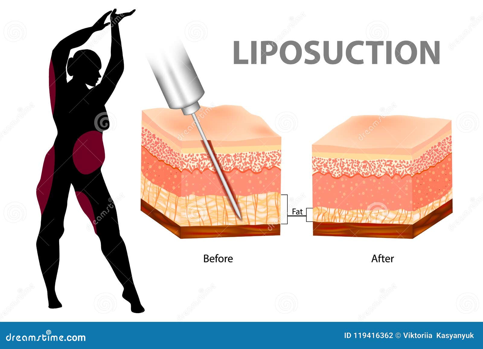 Liposuction of lipo vector illustratie. Illustration of geneeskunde ...