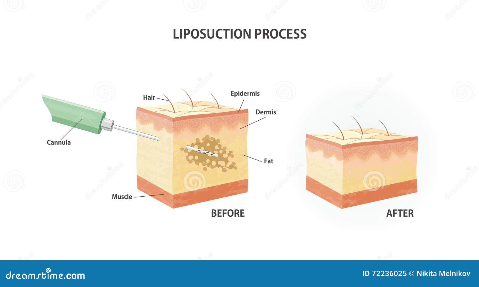 Liposuction process. stock vector. Illustration of skin - 72236025 Liposuction process. stock vector. Illustration of skin - 72236025
