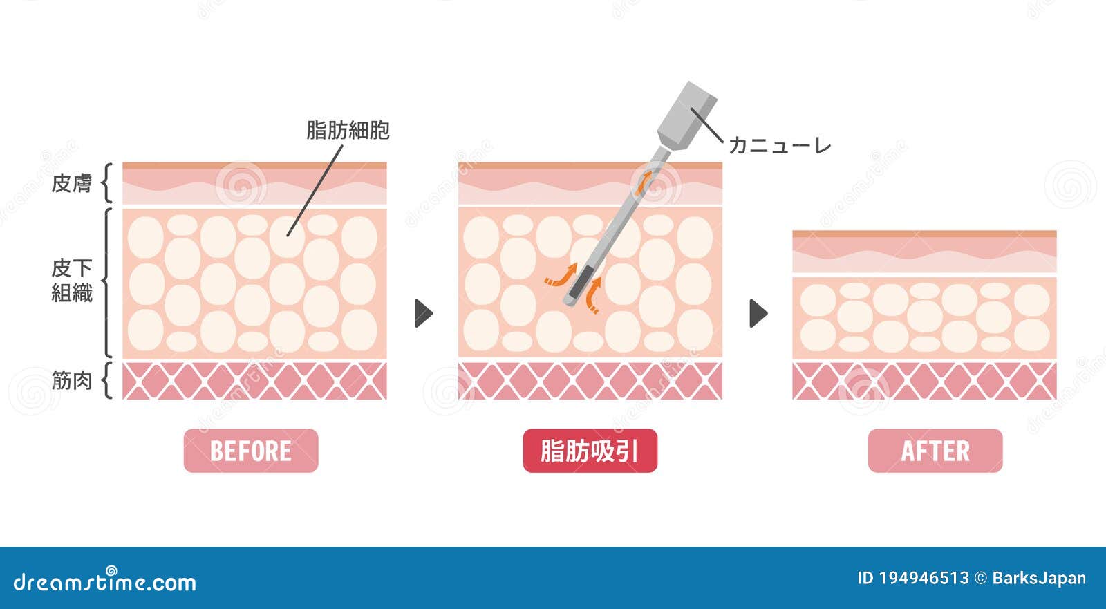 Liposuction Process Vector Illustration / Sectional View of Skin Stock ...