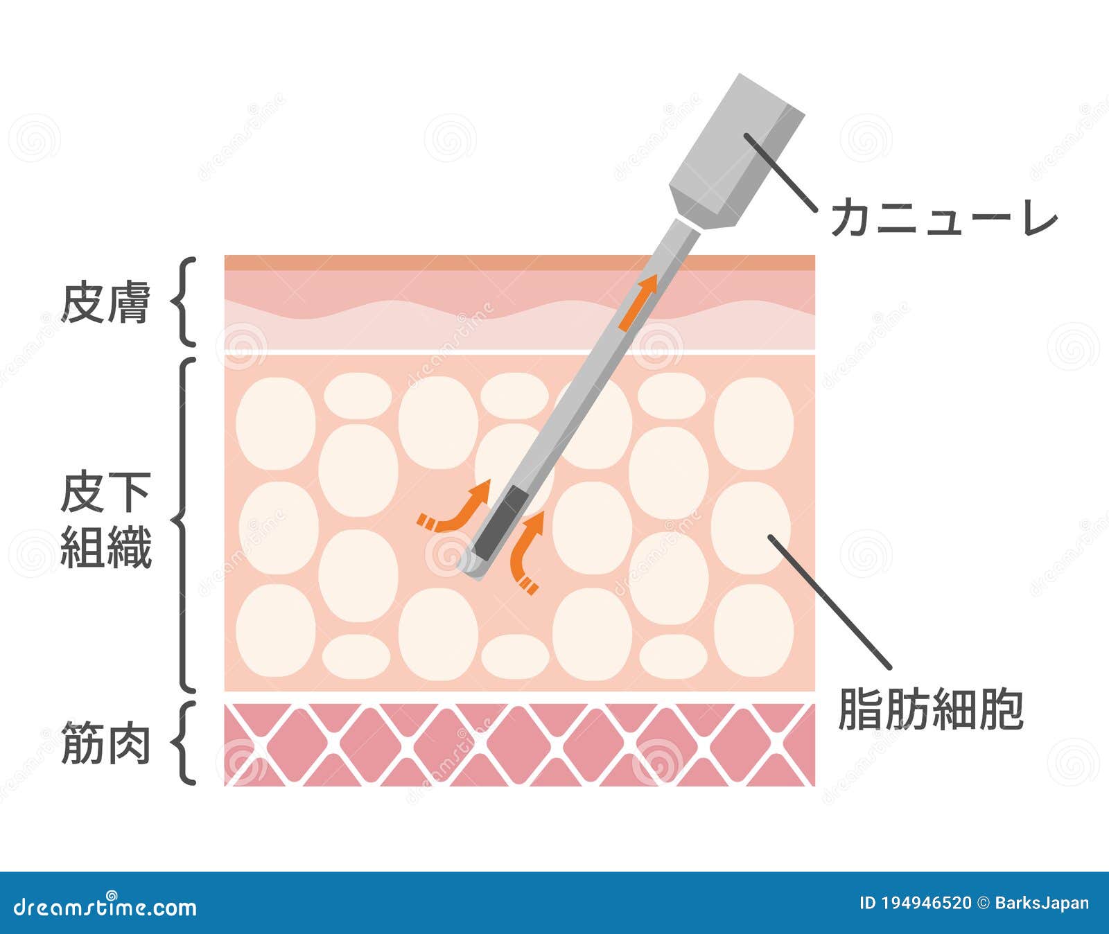 Liposuction Process Vector Illustration / Sectional View of Skin Stock ...