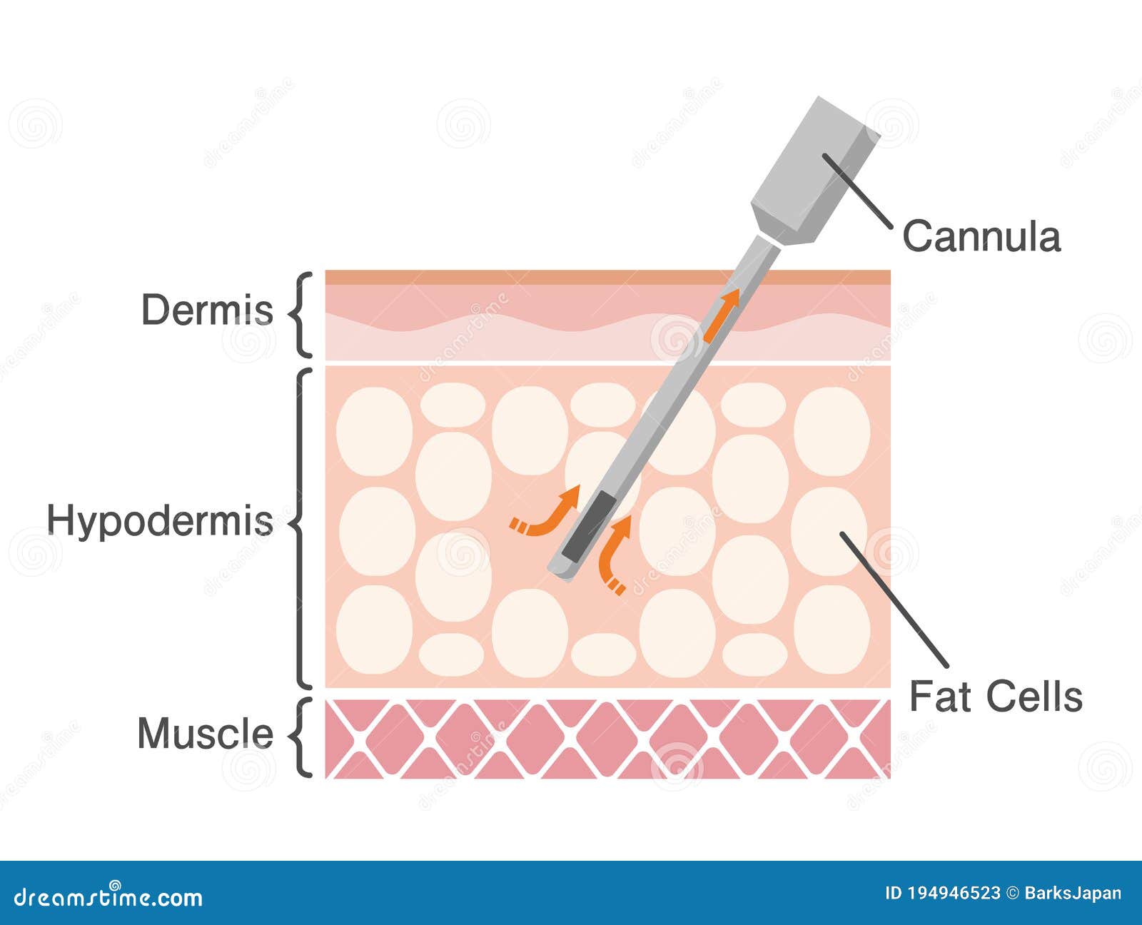 Liposuction Process Vector Illustration / Sectional View of Skin Stock ...