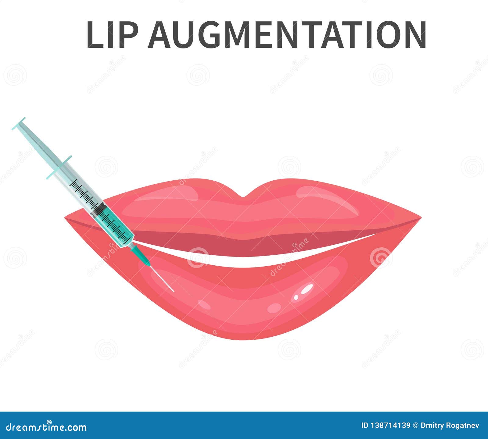 Lips Injection, Lip Augmentation. Injectable Cosmetic Filler. Vector ...