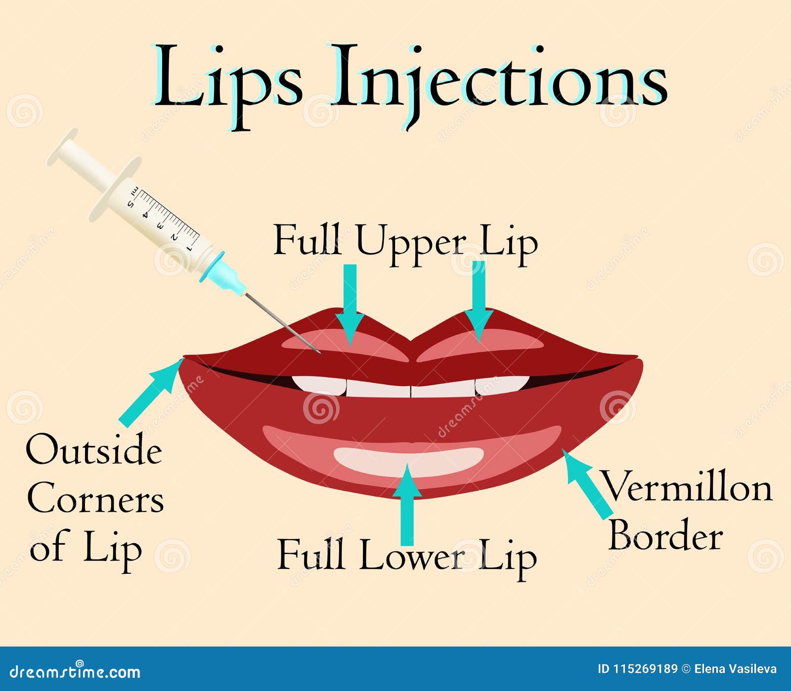 Lips Injection Vector Illustration Stock Vector - Illustration of mouth ...