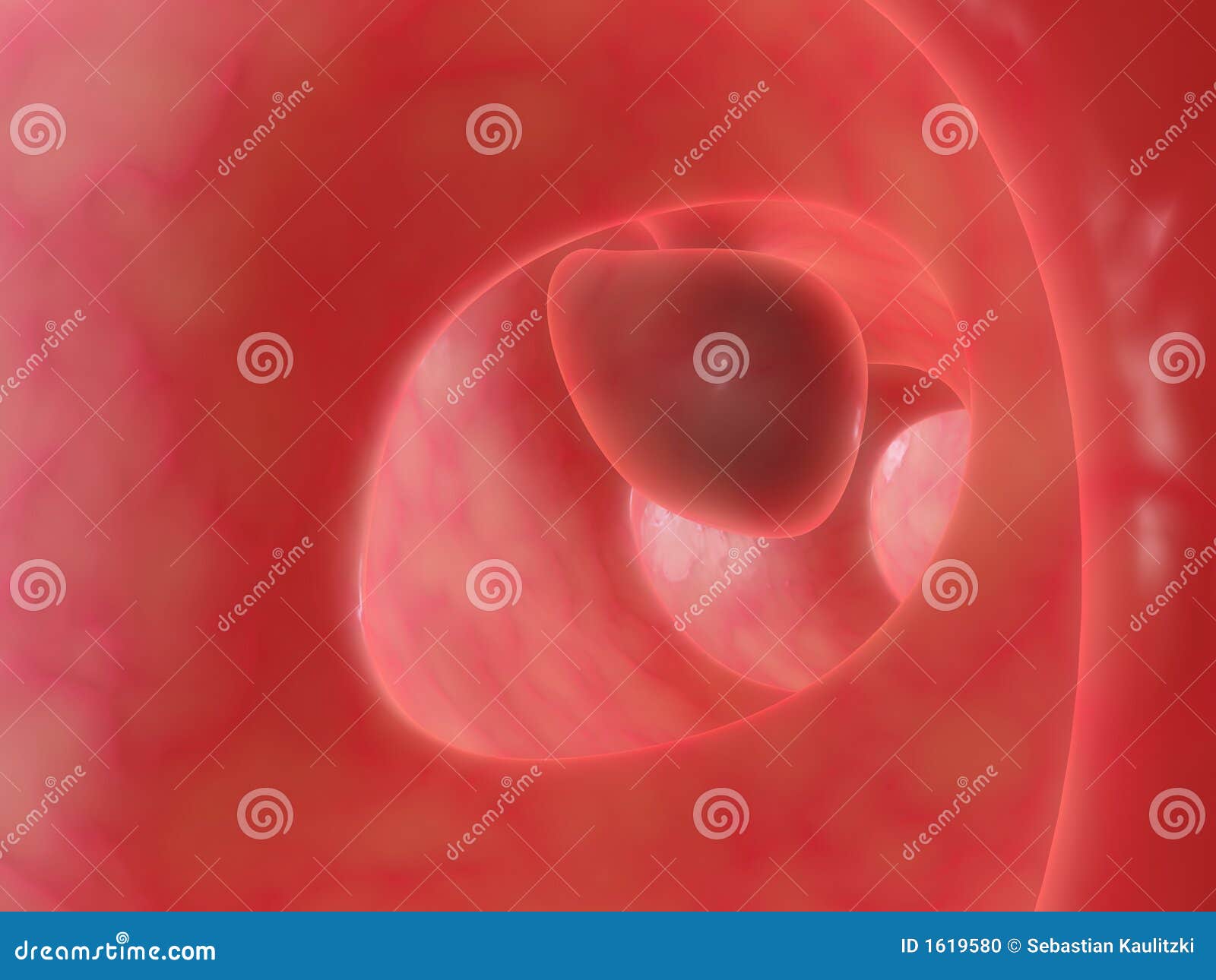Liten tarmpolyp stock illustrationer. Illustration av sjukdom - 1619580