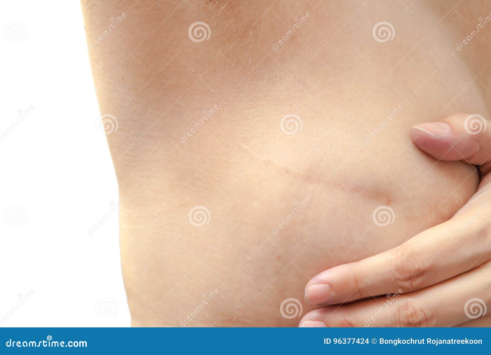 Litteken Van De Verrichting Van Borstkanker Stock Foto - Image of ...