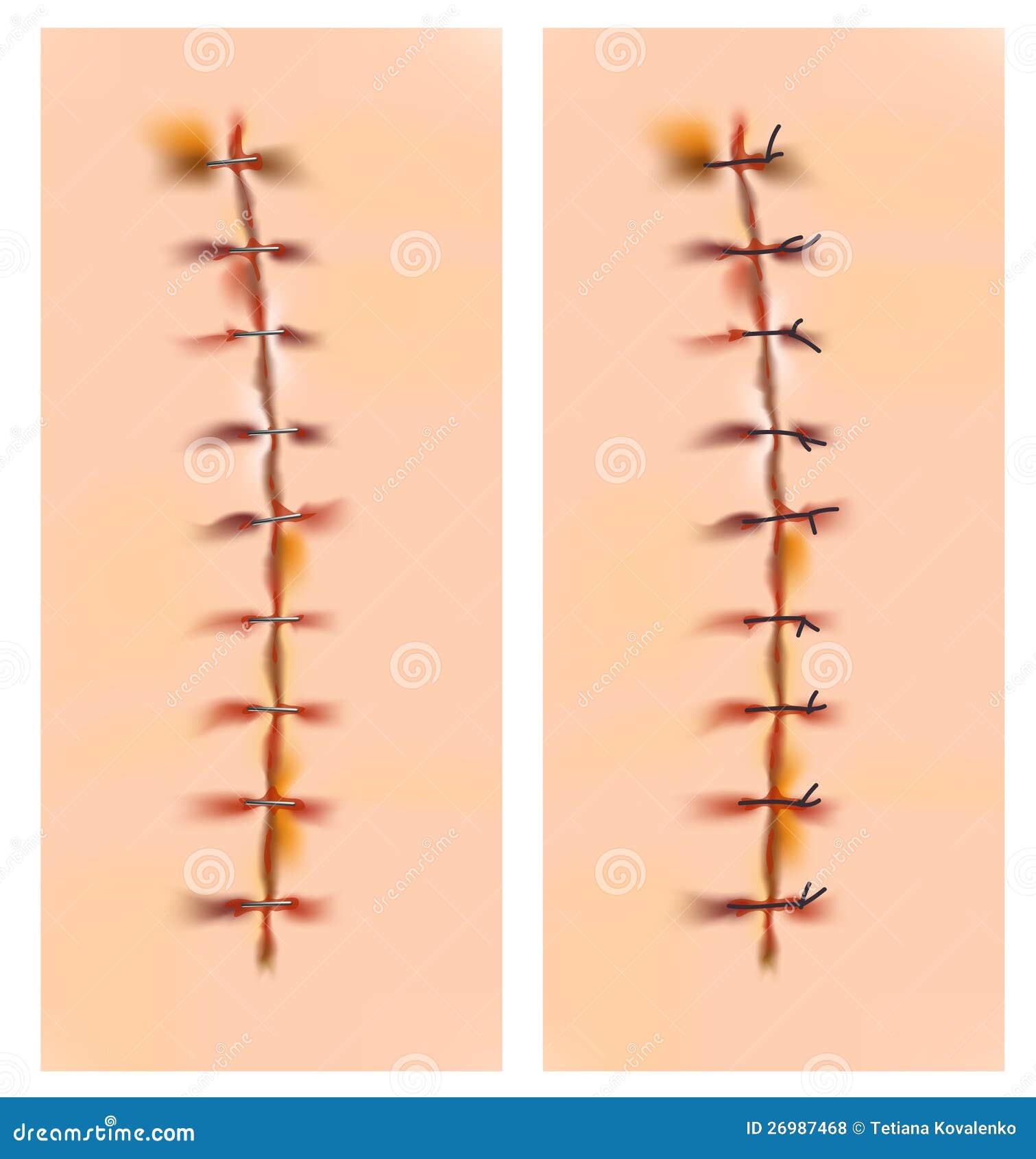 Littekens Met Nietjes En Hechtingen. Vector Illustratie - Illustration ...