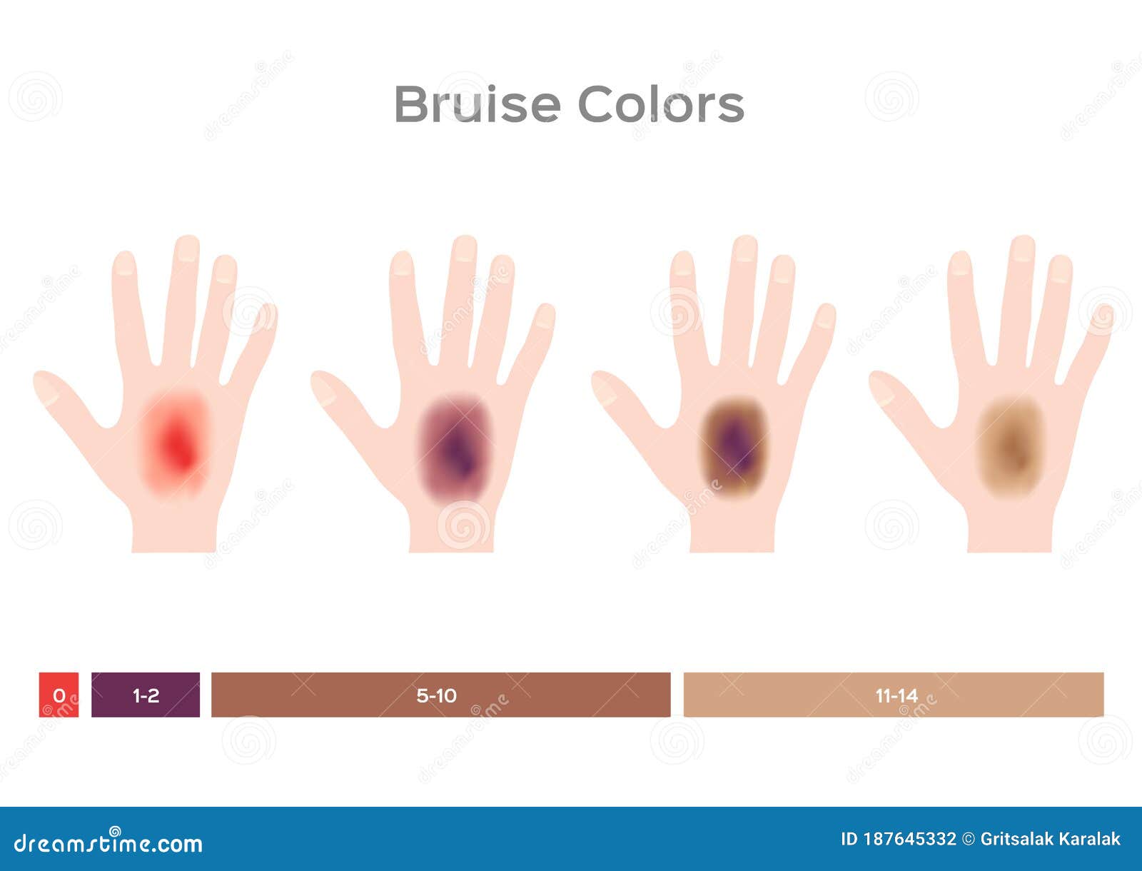 Serious Bruised . It Bleeding In Side The Skin Vector | CartoonDealer ...