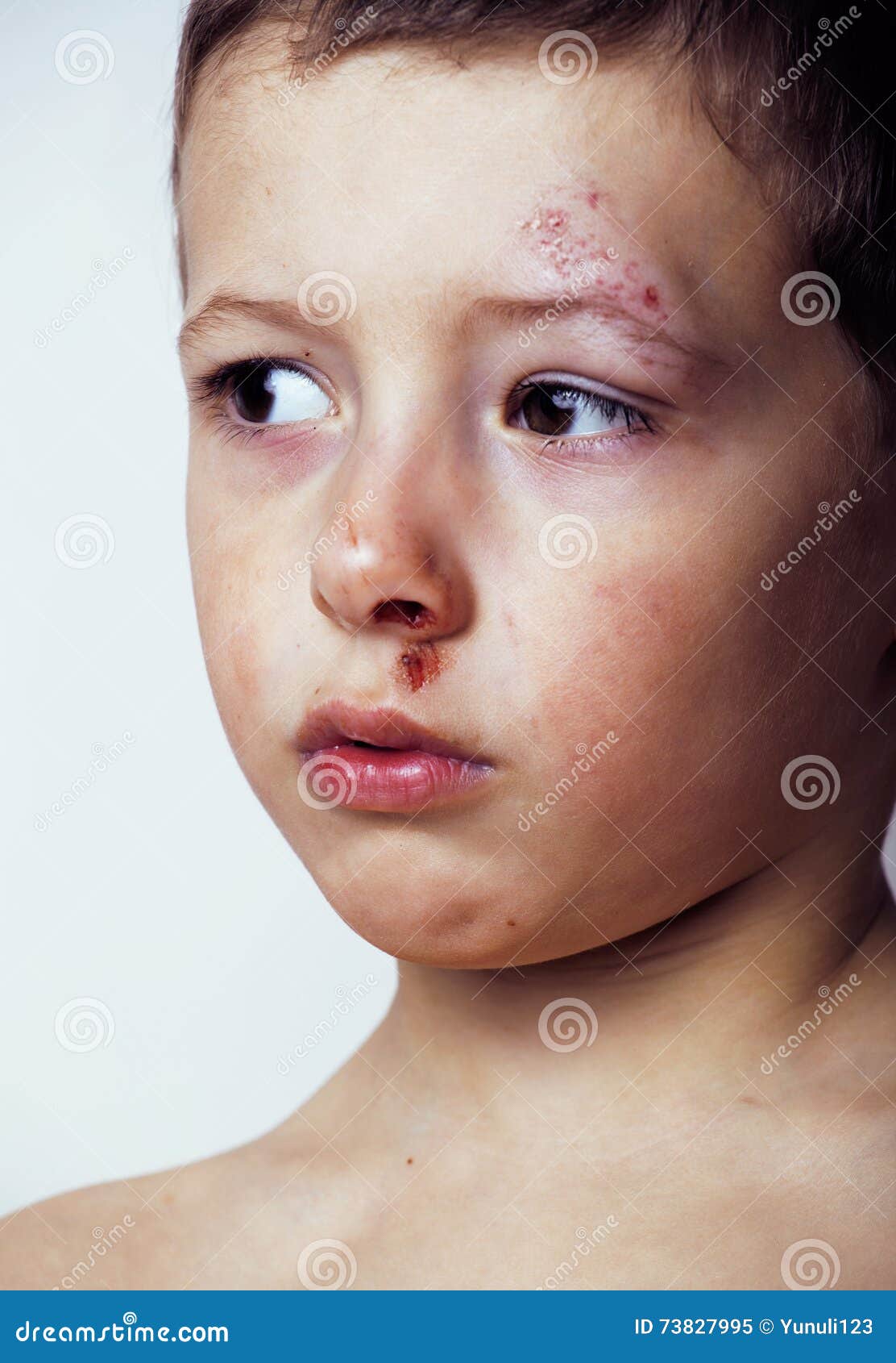 Little Boy Whipped Close Up Stock Image - Image of little, accident ...