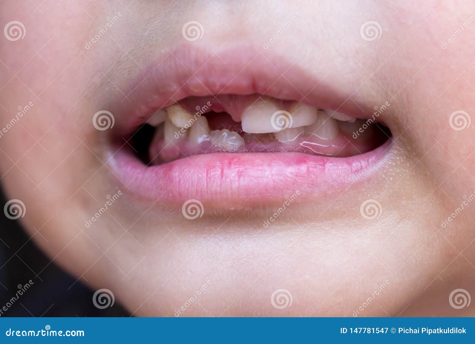 Little Child and Broken Teeth Stock Image - Image of hold, cute: 147781547