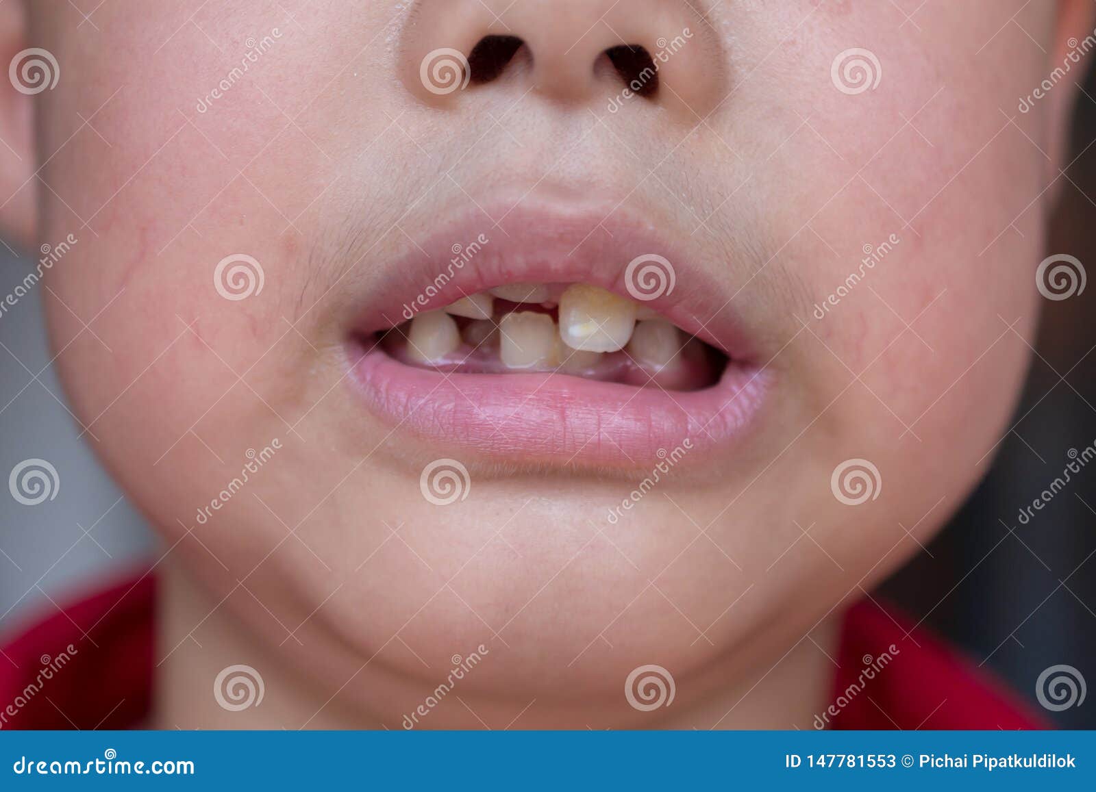 Little Child and Broken Teeth Stock Image - Image of hold, food: 147781553