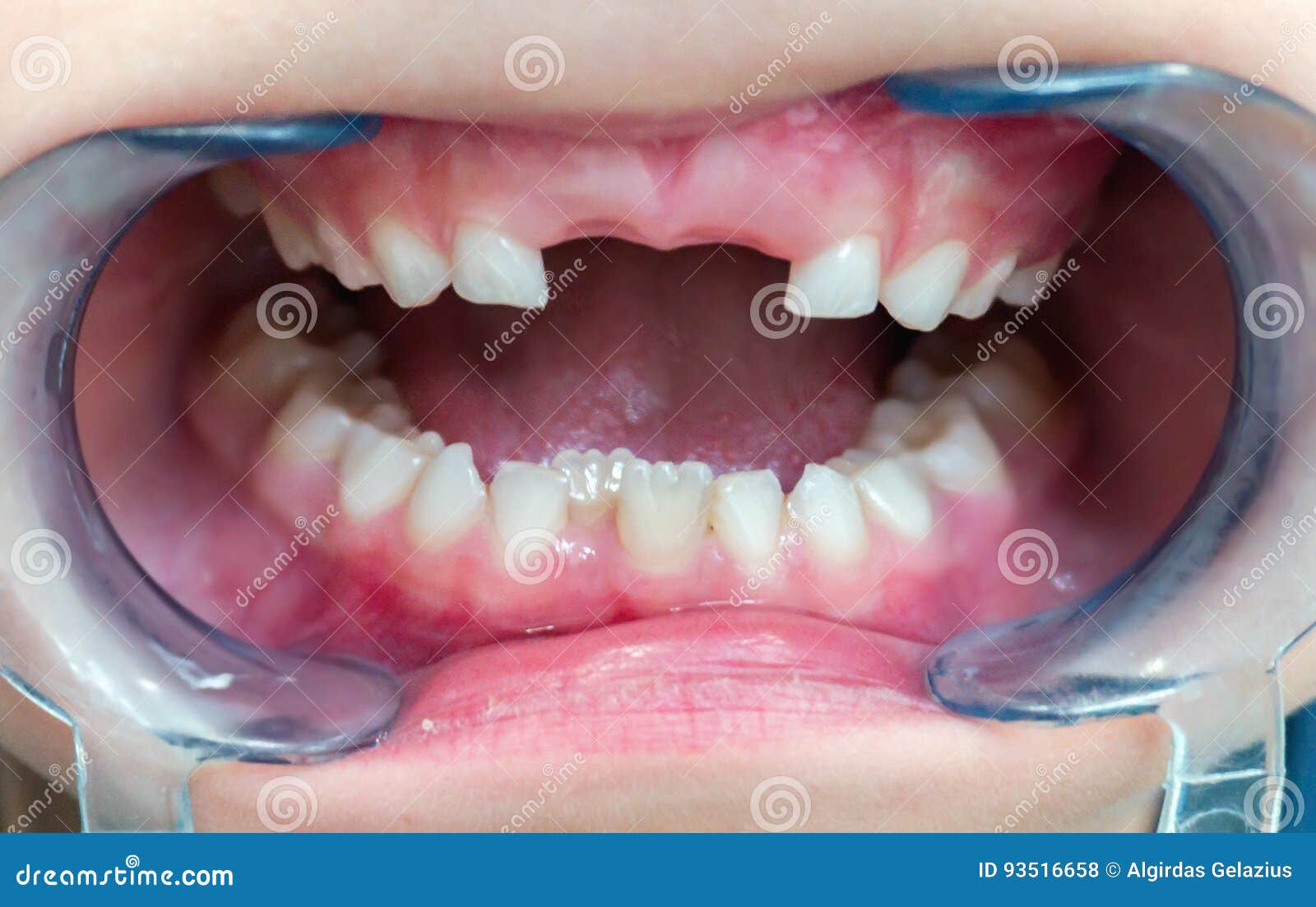 Little Child`s Broken Teeth Stock Photo - Image of person, dental: 93516658