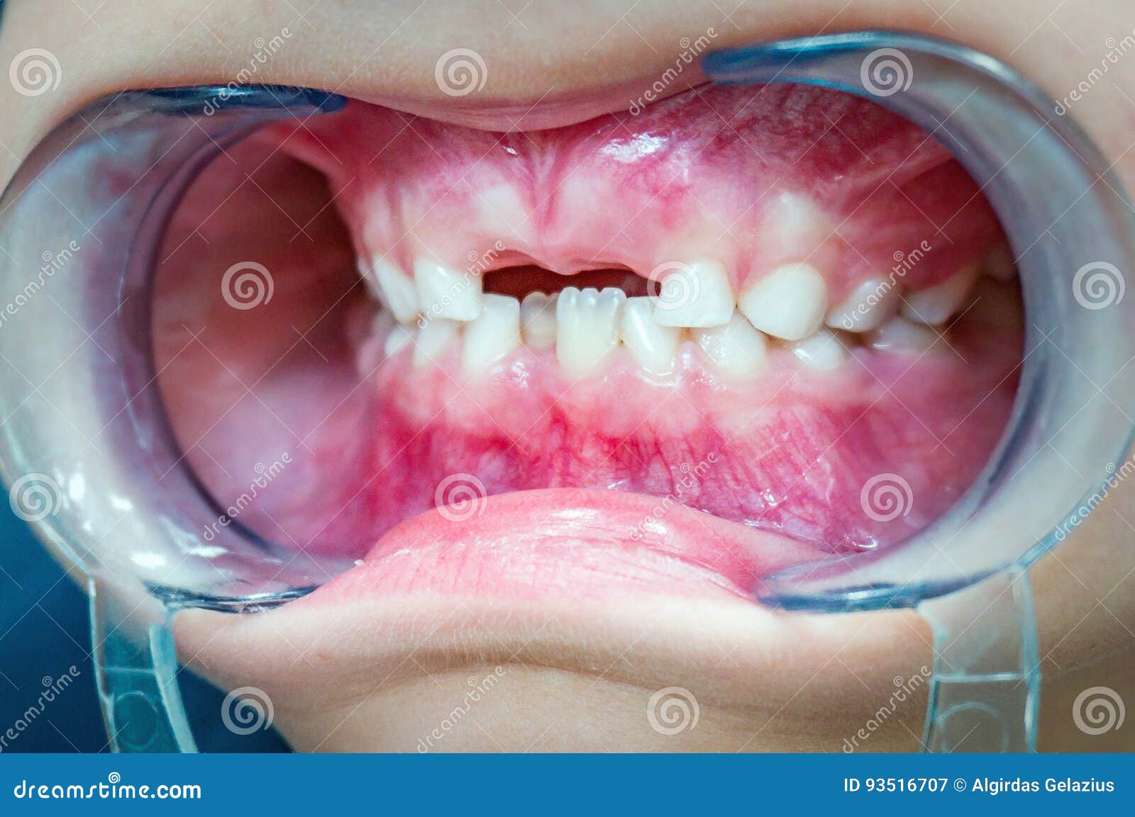Little Child`s Broken Teeth Stock Image - Image of childhood, patient ...
