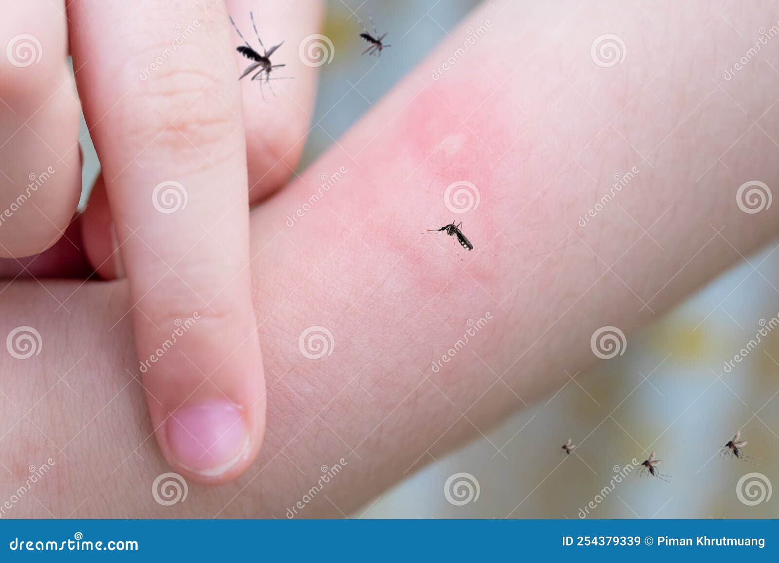 Little Girl Has Skin Rash Allergy Itching and Scratching on Her Arm ... Little Girl Has Skin Rash Allergy Itching and Scratching on Her Arm ...