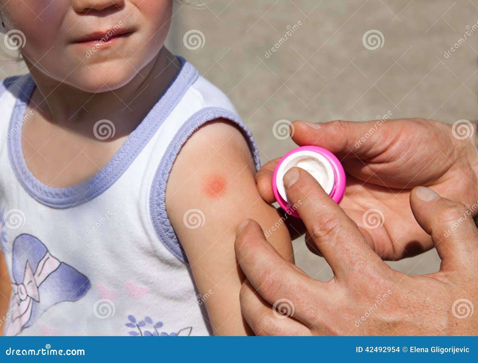 Mosquito Bite On Child Back. Allergic Reaction, Inflamed And Reddened ...