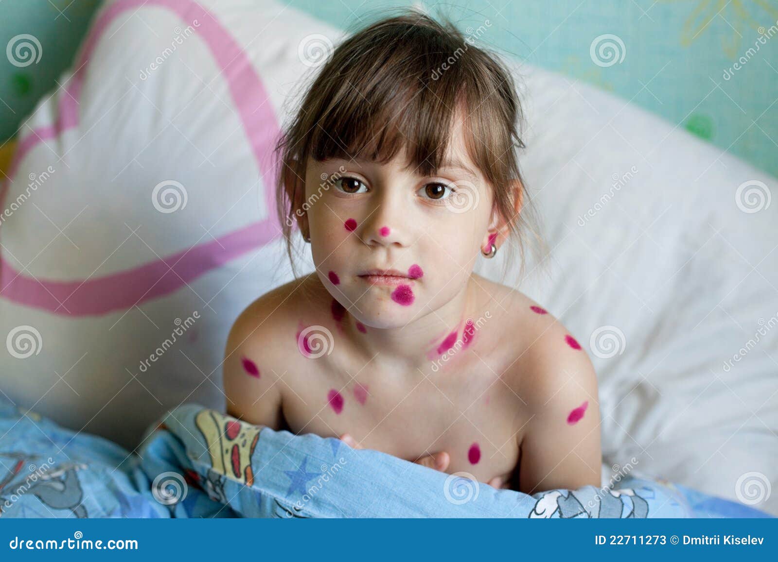 The Little Girl Suffering from Chicken Pox Stock Image - Image of ...