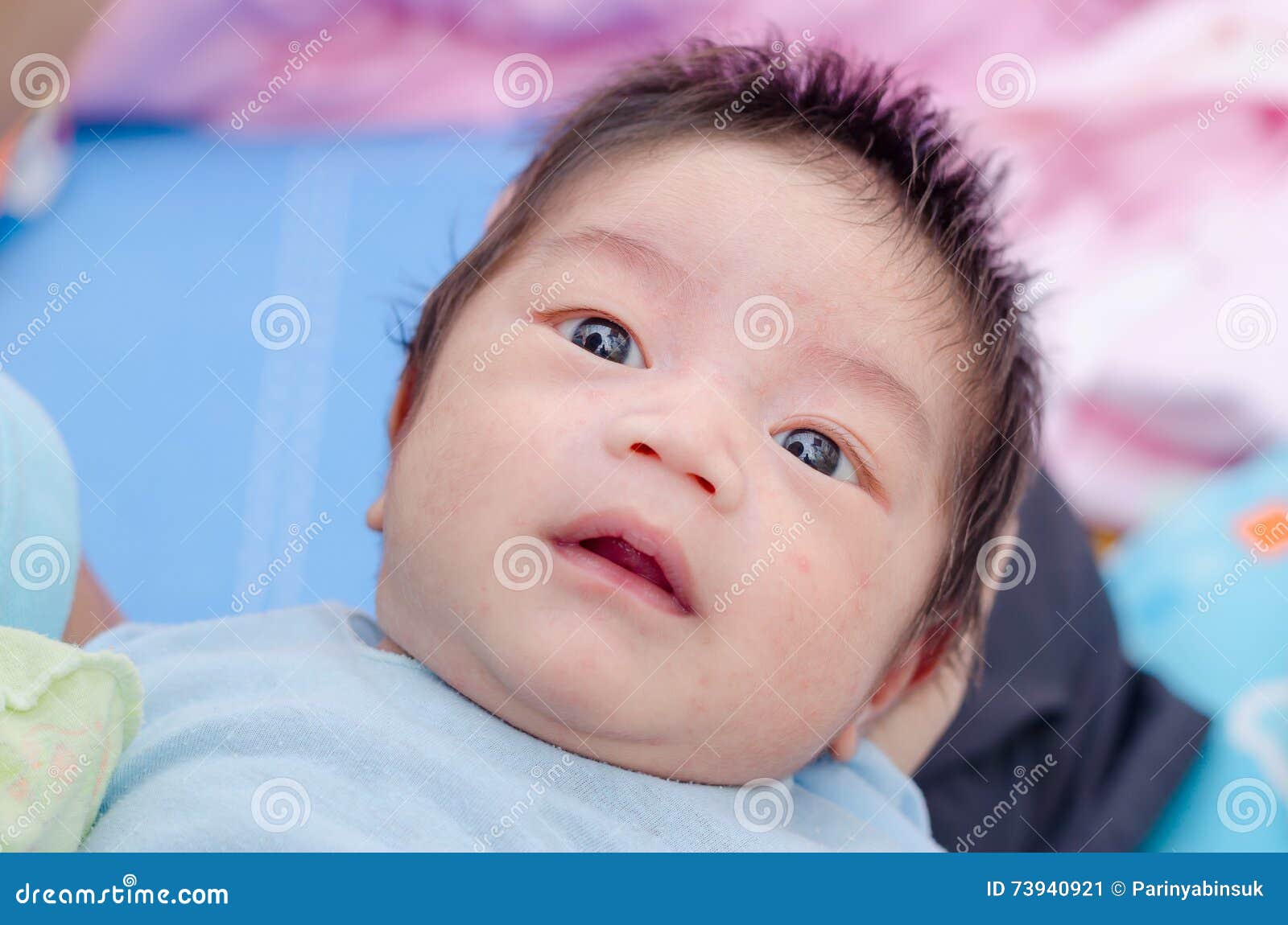 Little Newborn with Many Rash on Face Stock Image - Image of infant ...