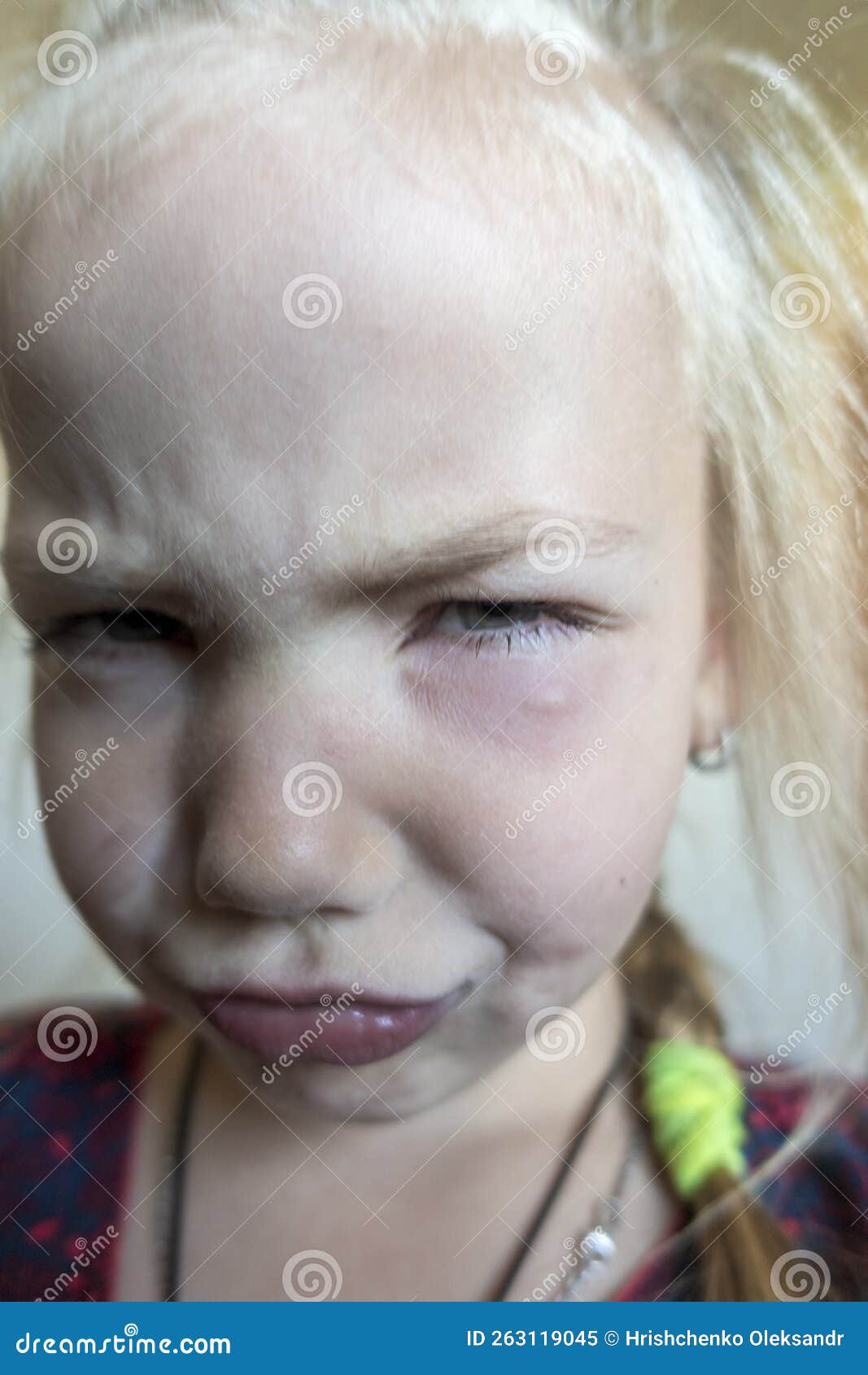 Little Upset Girl with a Bite Under the Eye Stock Image - Image of ...