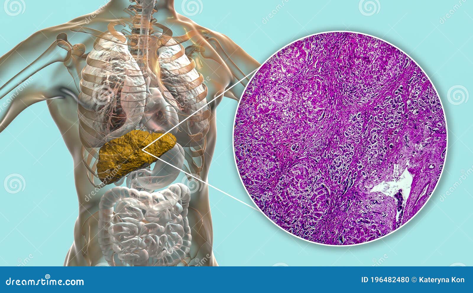 Liver With Biliary Cirrhosis Stock Illustration | CartoonDealer.com ...