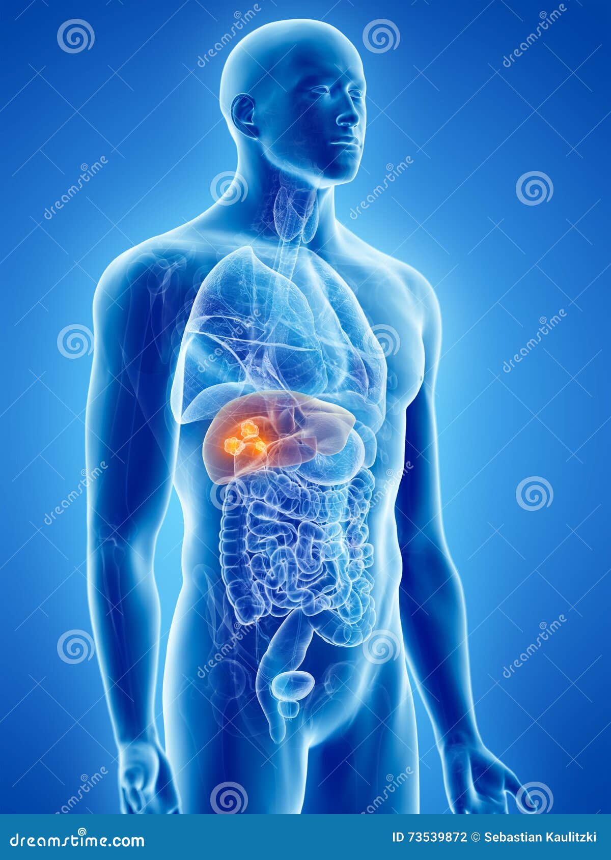 Liver Cancer. Internal Organs Of Man. Surgery. Vector Flat Illustration ...