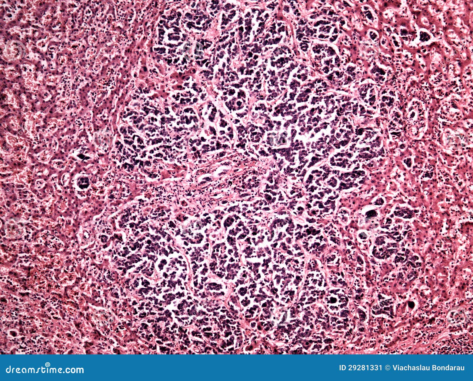 Liver cancer of a human stock image. Image of microscope - 29281331