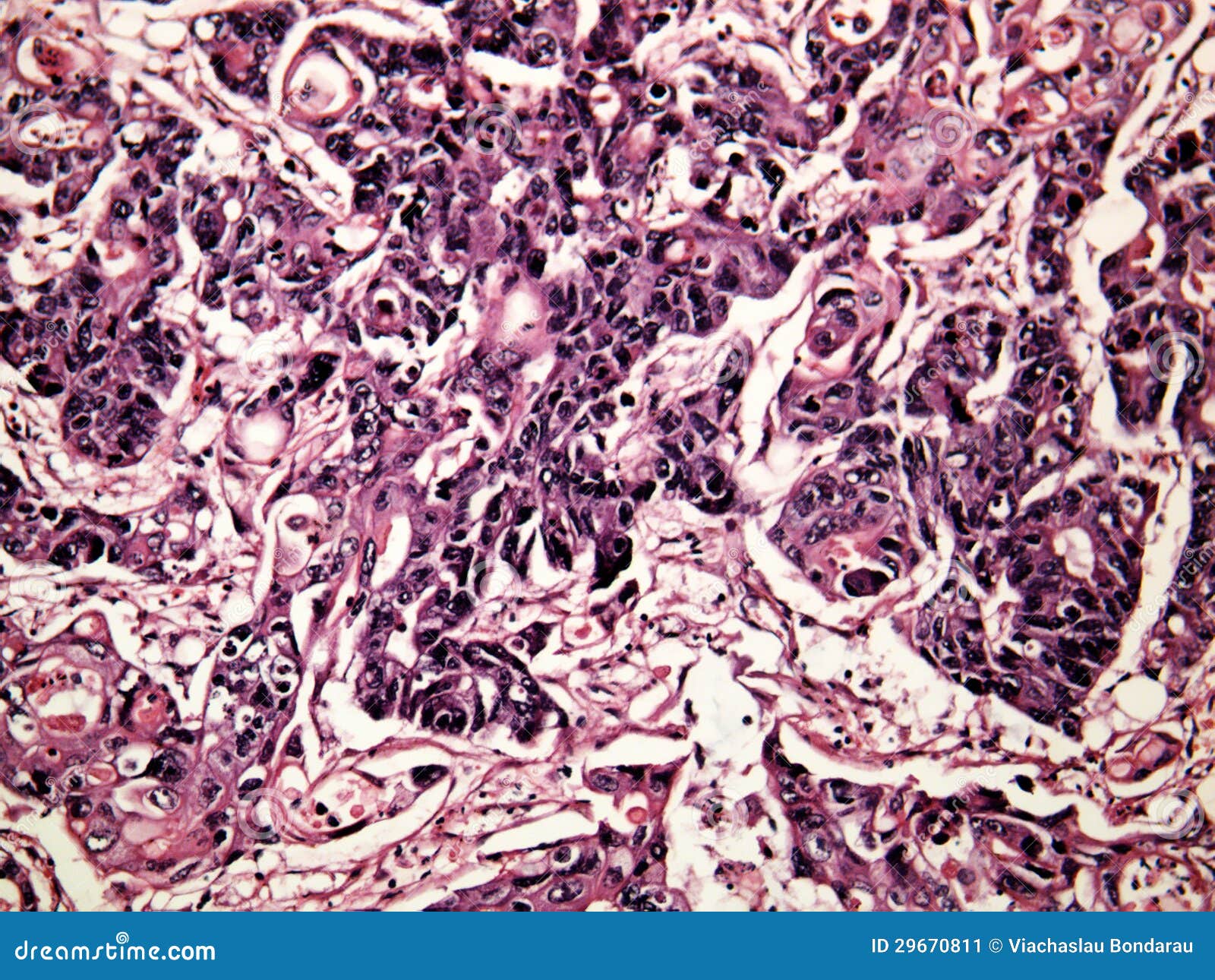 Liver cancer of a human stock image. Image of clinical - 29670811