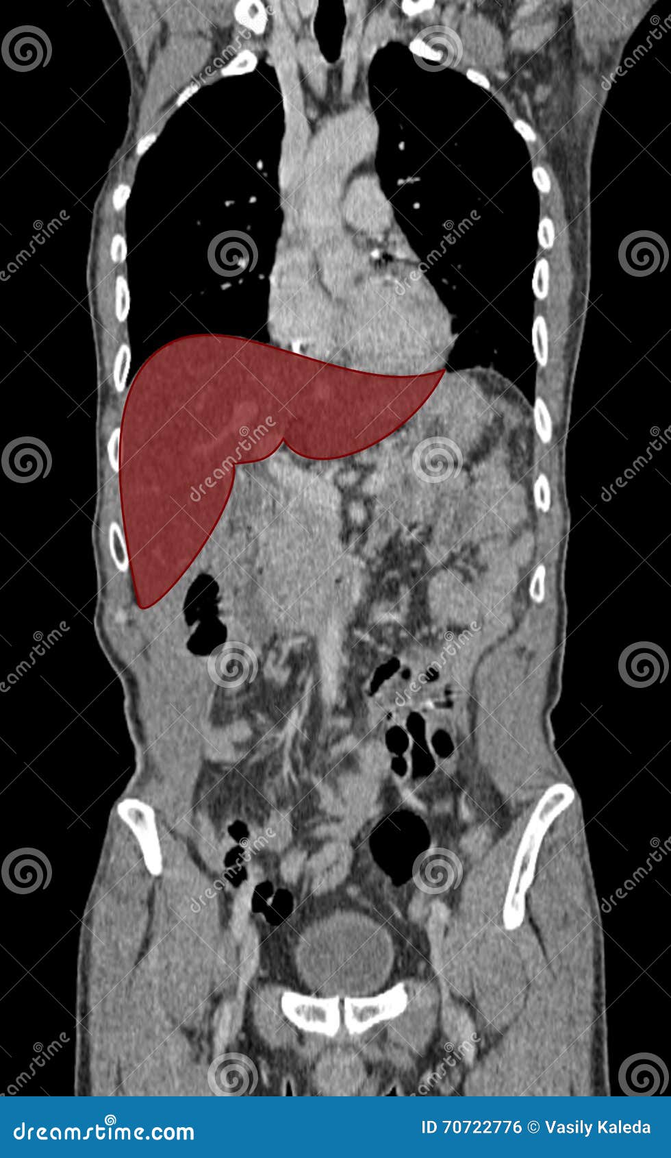 Liver on Computed Tomography Stock Photo - Image of liver, black: 70722776