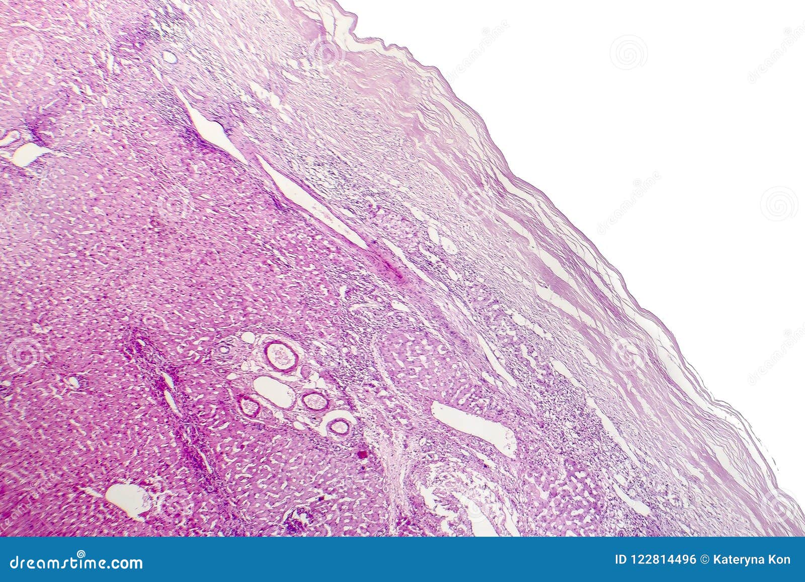 Liver cyst formation stock photo. Image of histology - 122814496