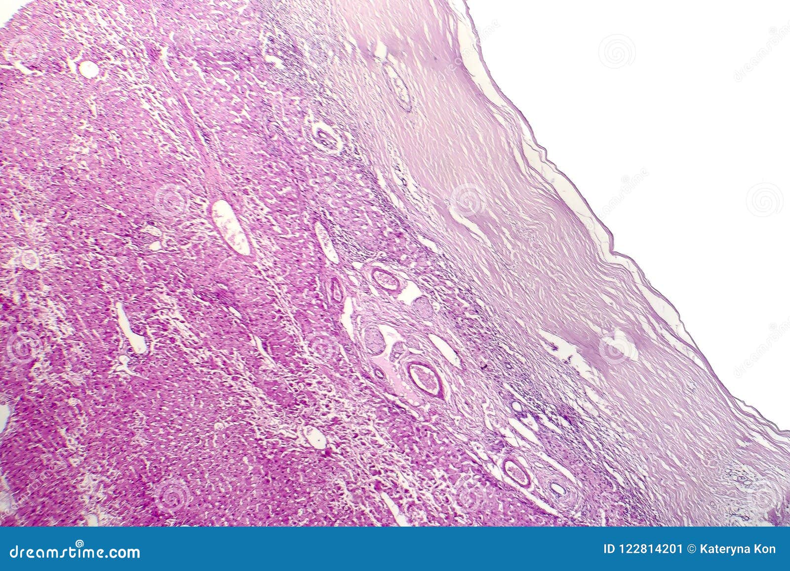 Liver cyst formation stock image. Image of histopathology - 122814201
