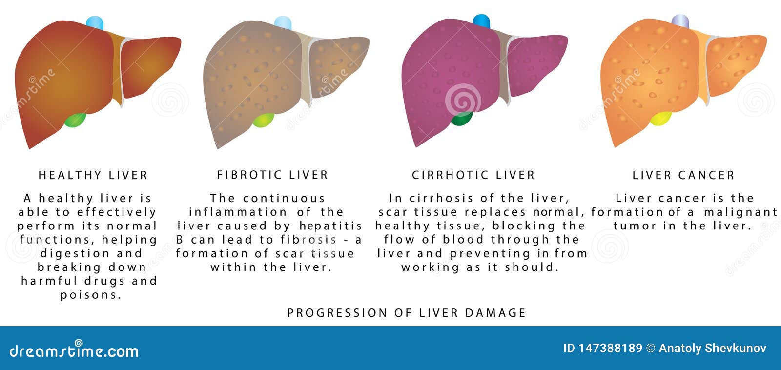 Liver Disease Symptoms Cartoon Style Cartoon Style Infographic ...