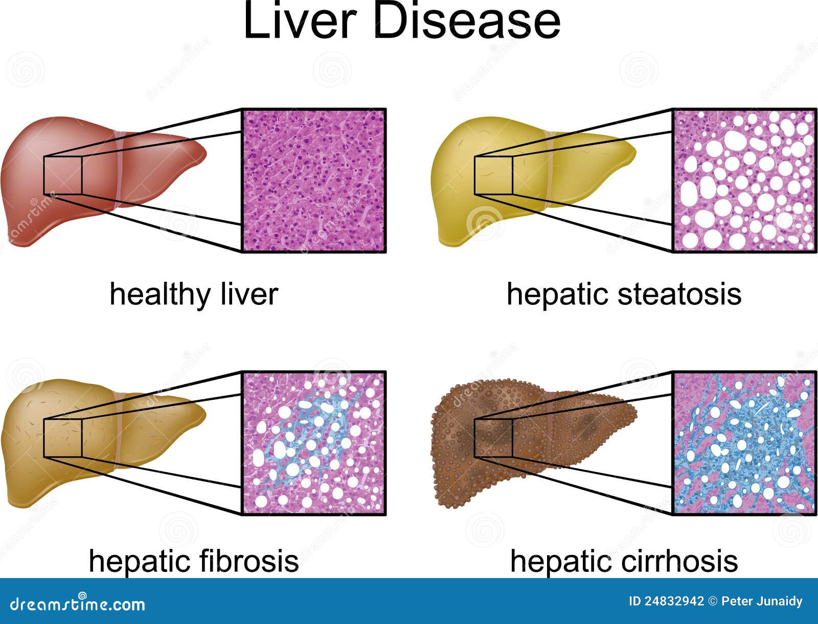 Cirrhosis Cartoons, Illustrations & Vector Stock Images - 5802 Pictures ...