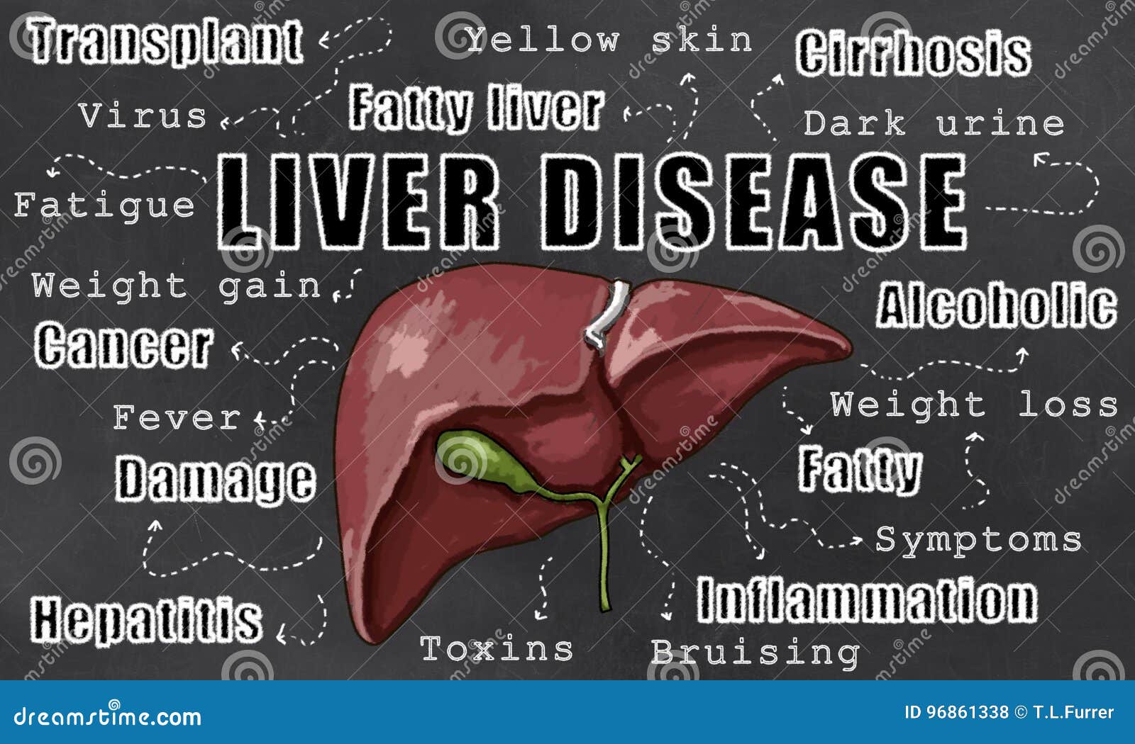Liver Disease Illustration stock illustration. Illustration of bladder ...