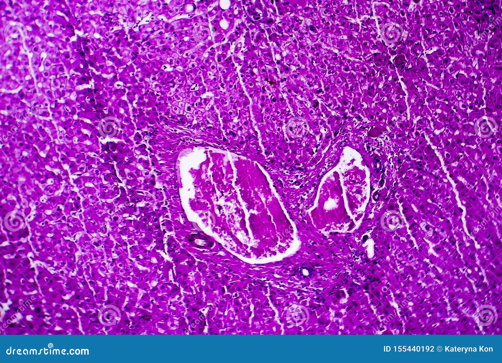 Liver Edema, Light Micrograph Stock Photo - Image of medical ...