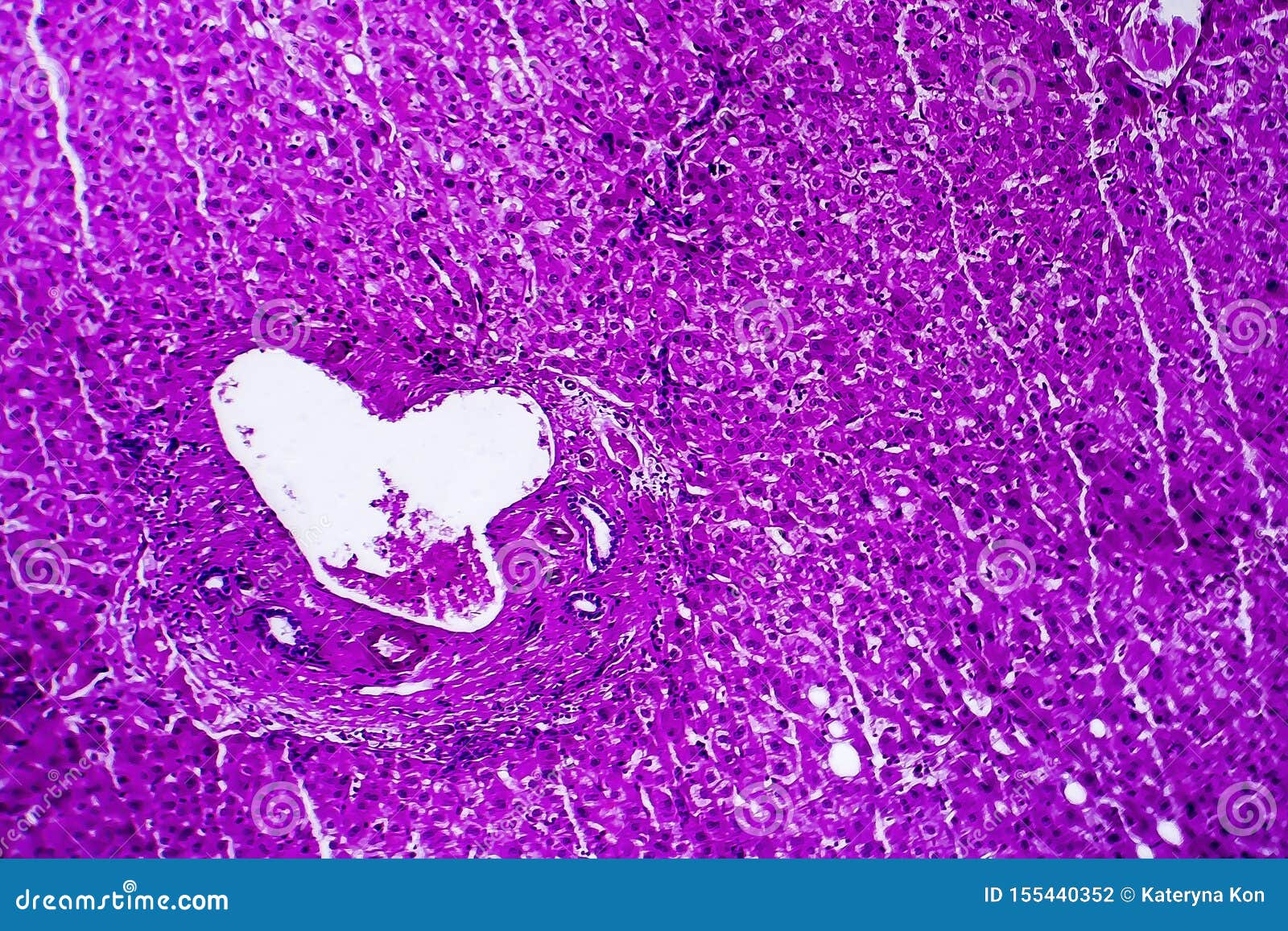 Liver Edema, Light Micrograph Stock Photo - Image of microscopic ...