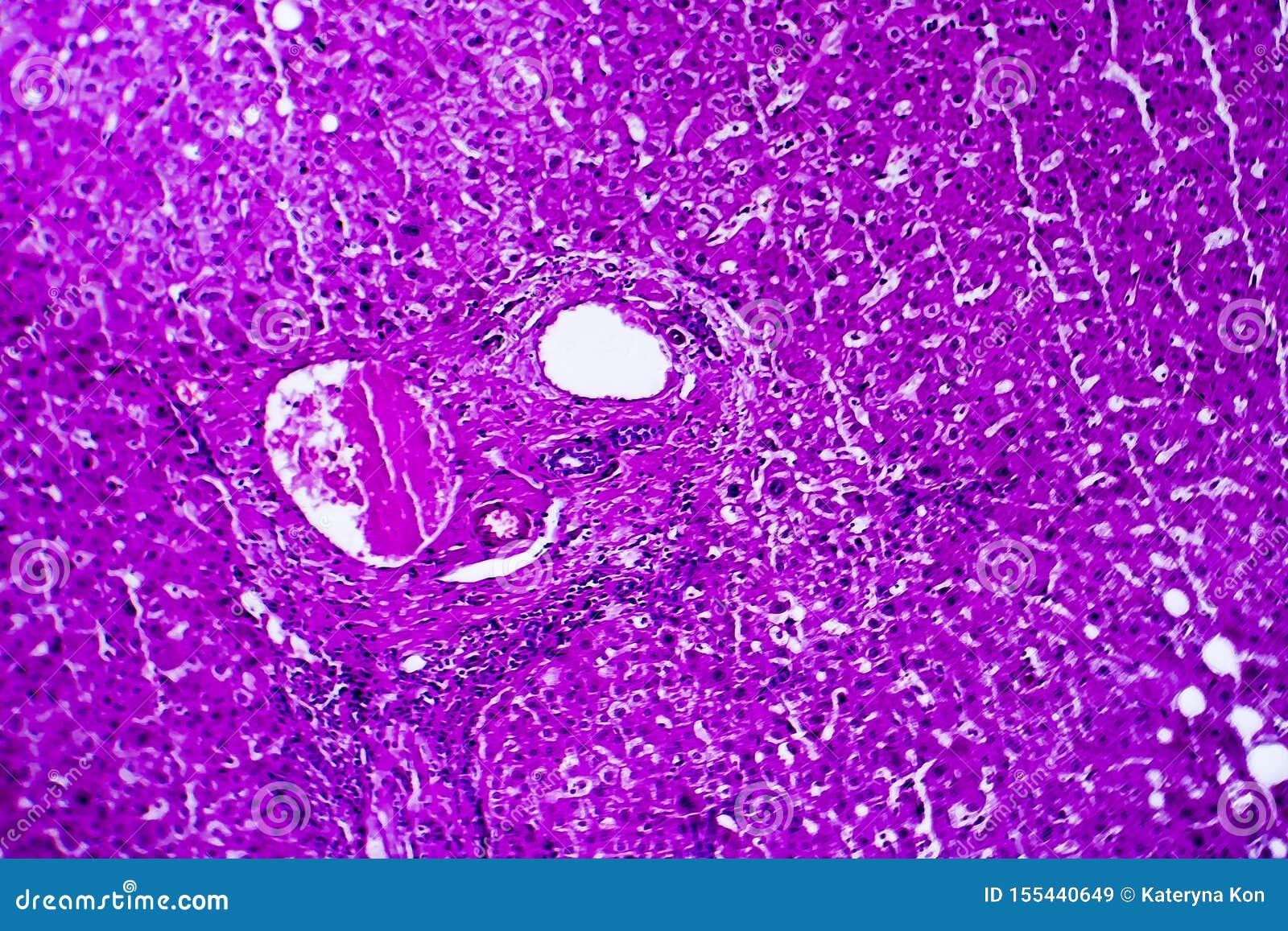Liver Edema, Light Micrograph Stock Image - Image of hepatobiliary ...