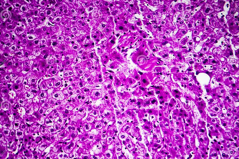 Liver Edema, Light Micrograph Stock Photo - Image of stain, medical ...