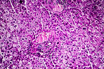 Liver Edema, Light Micrograph Stock Photo - Image of medicine ...