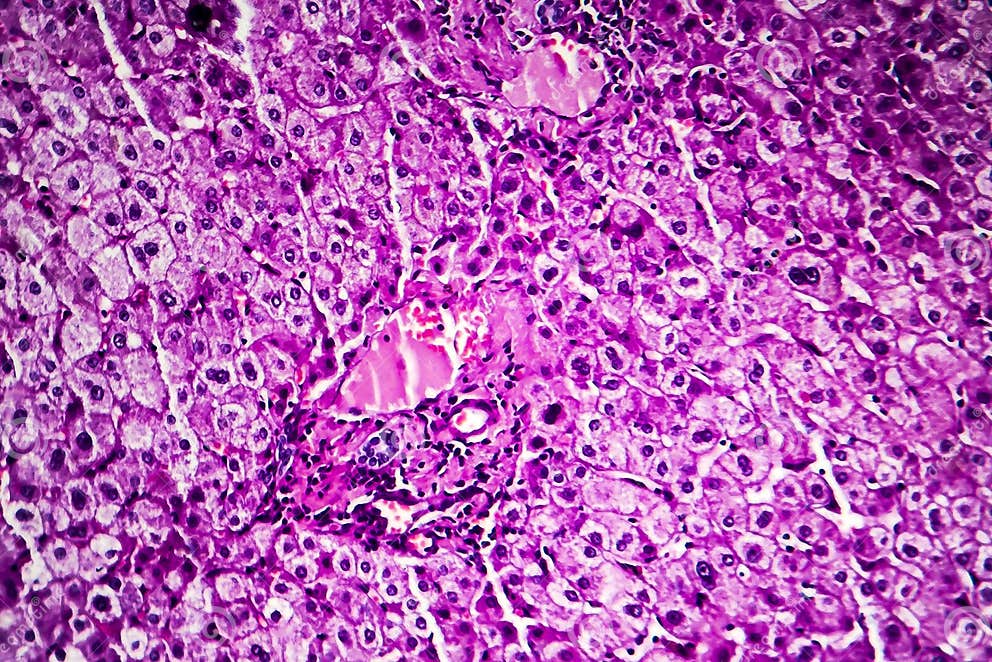 Liver Edema, Light Micrograph Stock Photo - Image of medicine ...