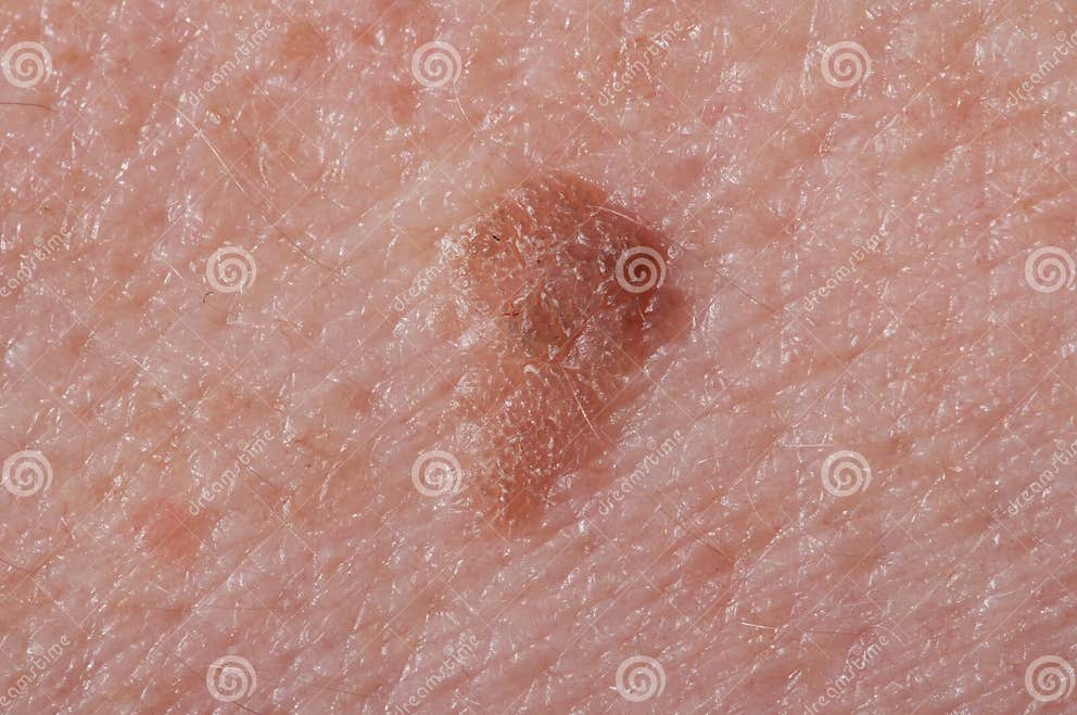 Liver spots stock image. Image of skin, face, insurance - 20238447