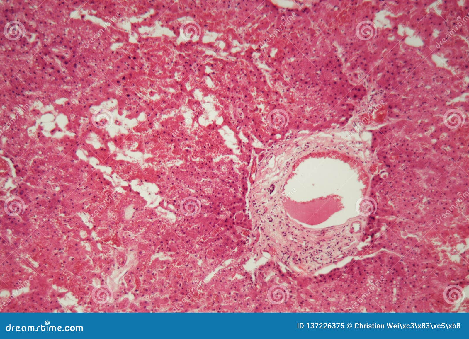 Liver Tissue with Amyloidosis Under a Microscope Stock Image - Image of ...