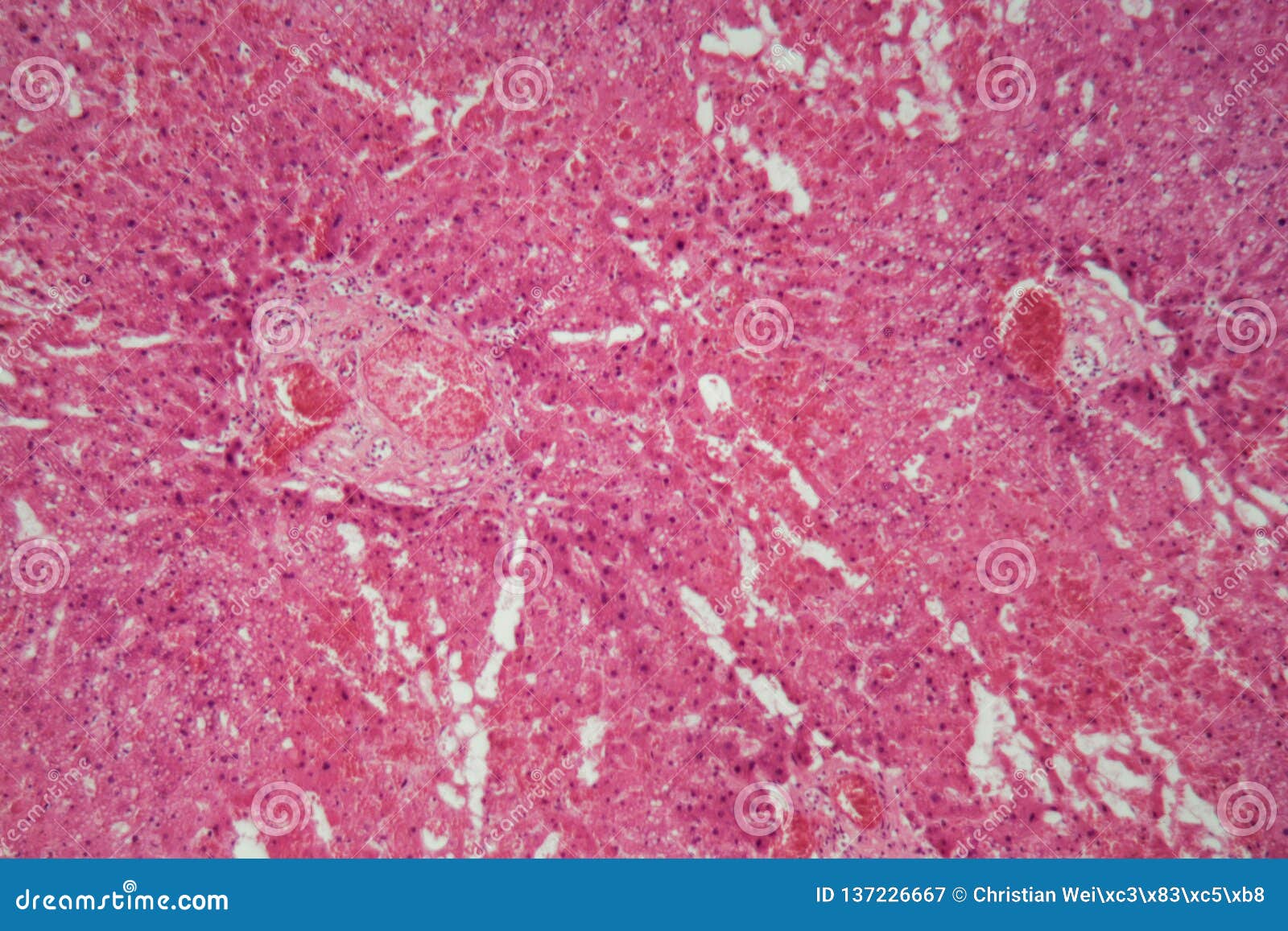 Liver Tissue with Amyloidosis Under a Microscope Stock Image - Image of ...