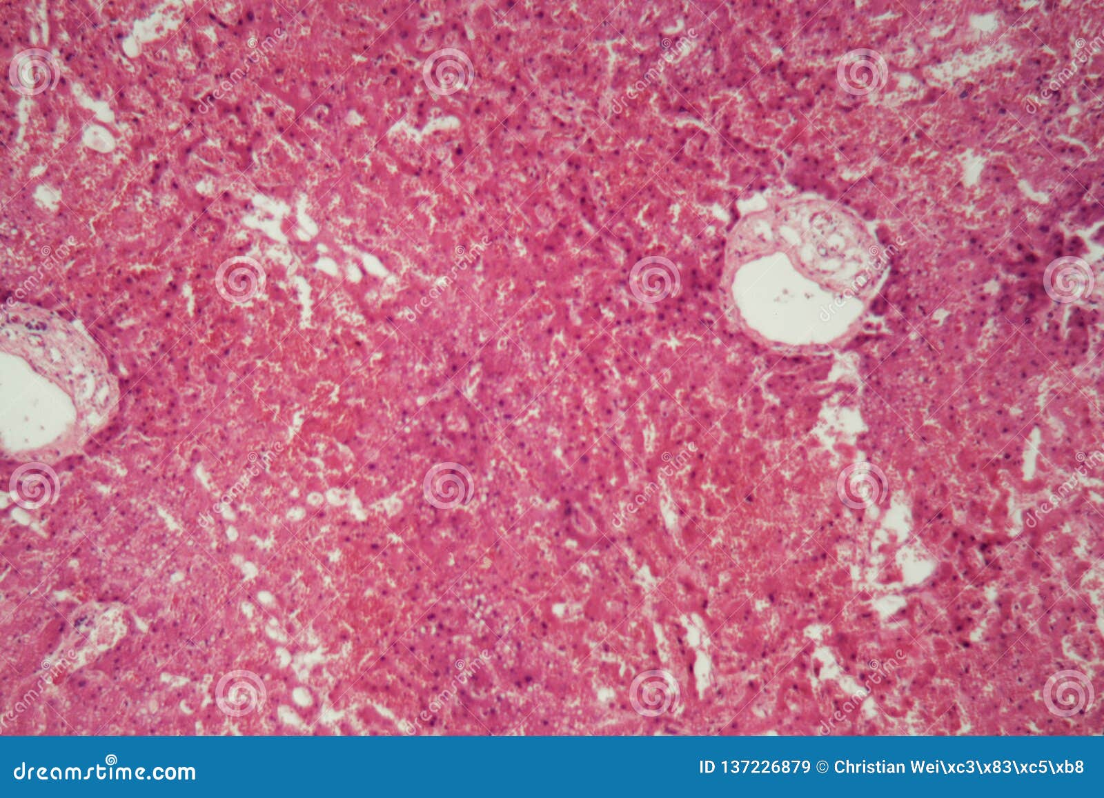 Liver Tissue With Amyloidosis Under A Microscope Royalty-Free Stock ...