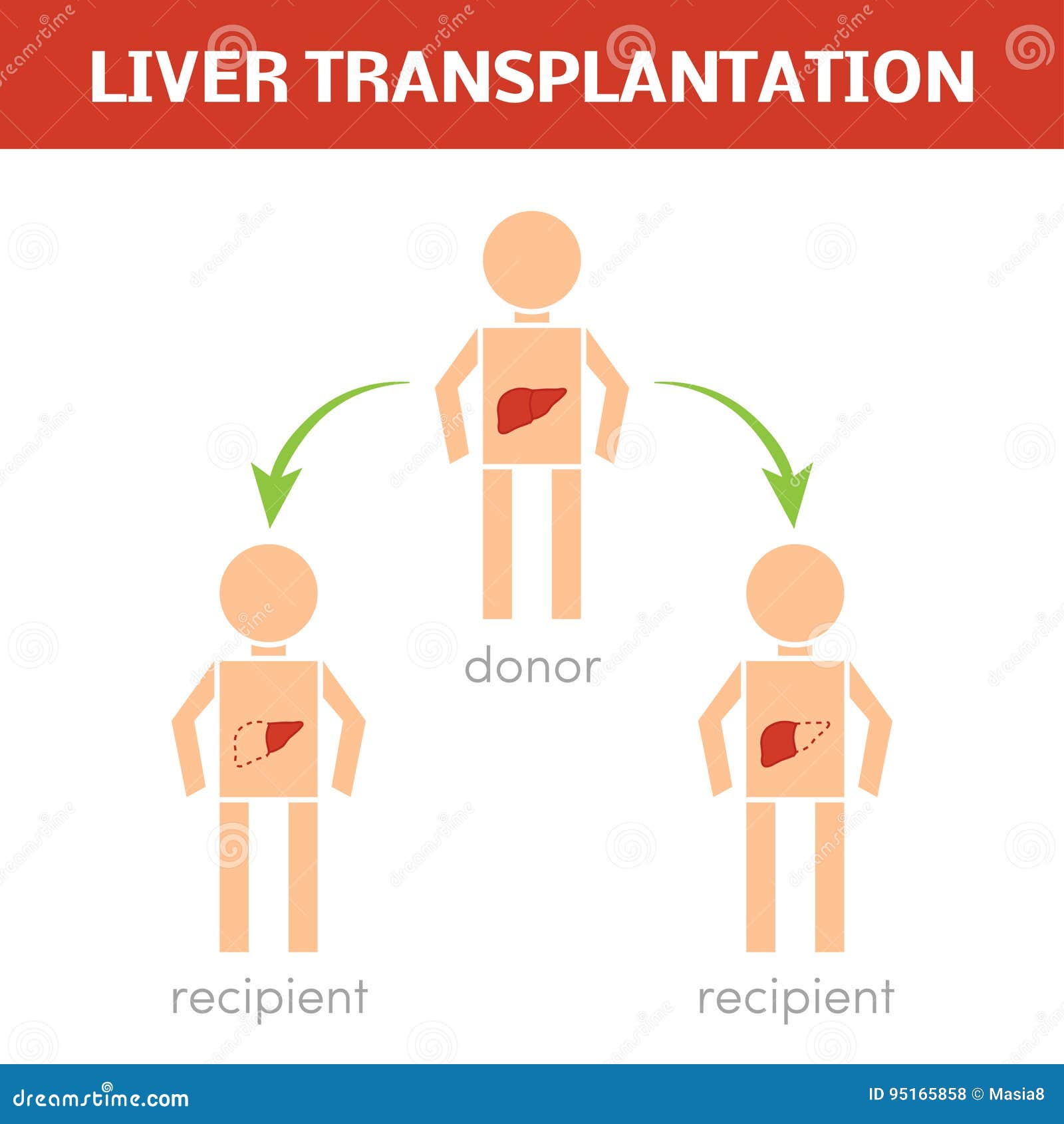 Liver Transplantation Concept Stock Illustration - Illustration of ...
