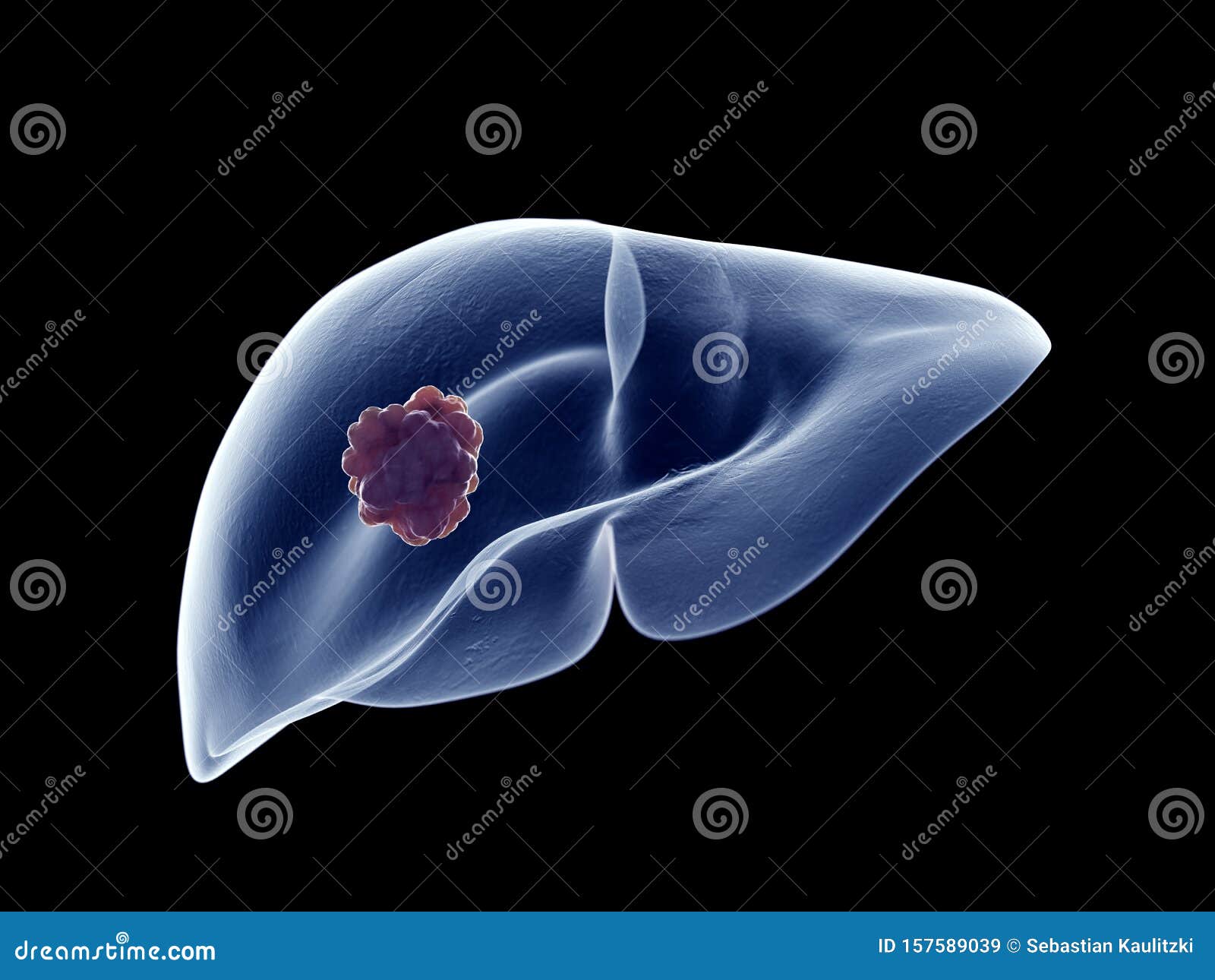 A liver tumor stock illustration. Illustration of hemochromatosis ...
